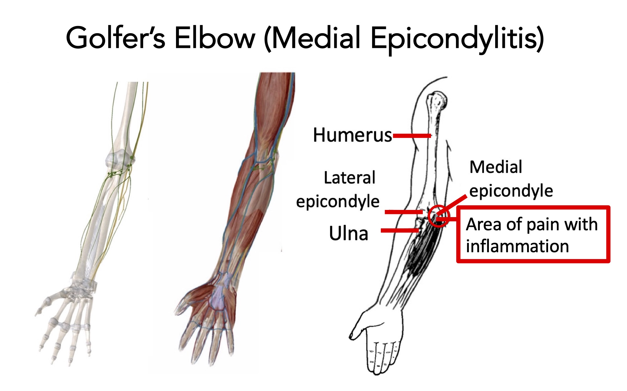 Golfer’s Elbow (Medial Epicondylitis) – Journey with Parkinson's
