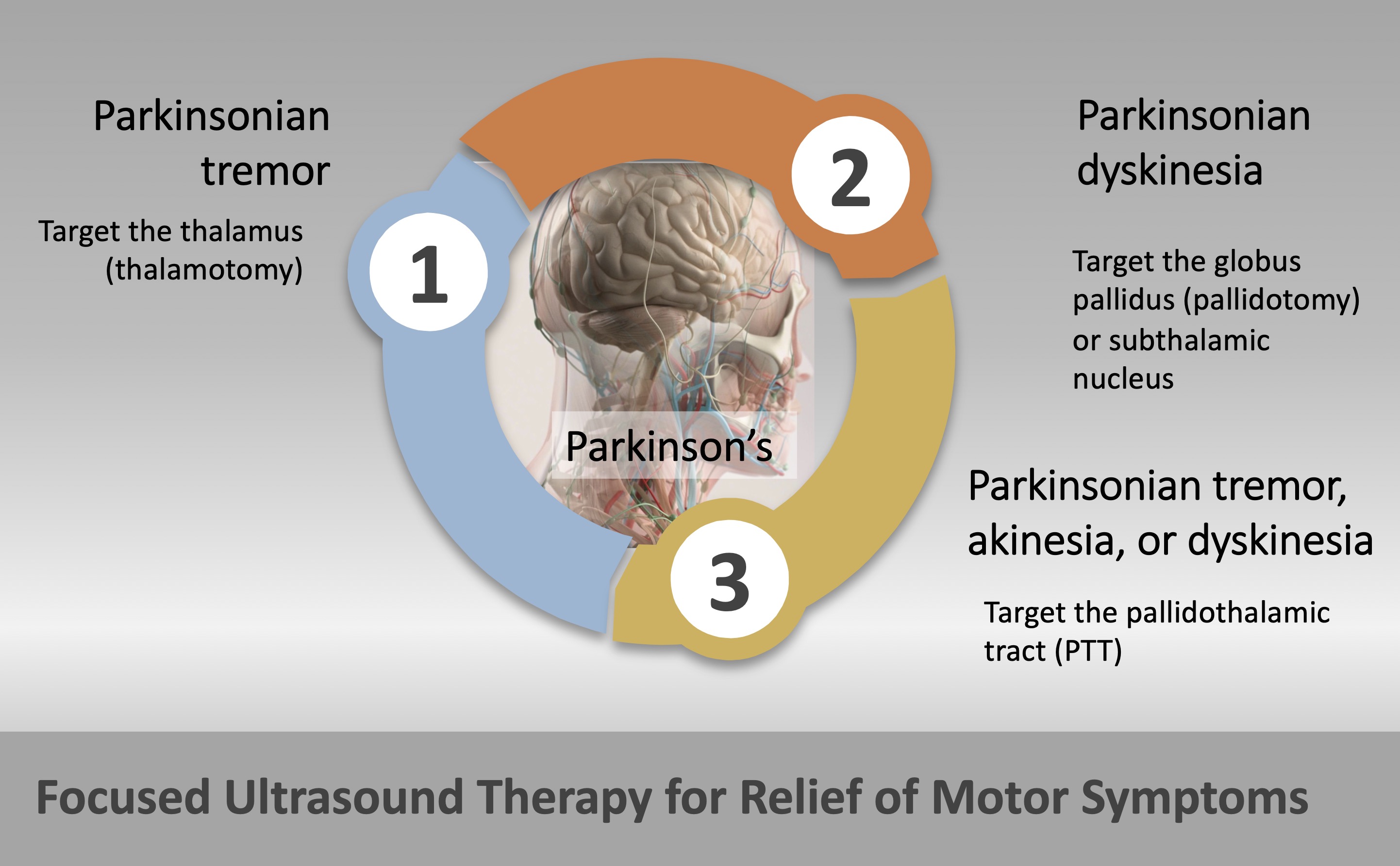 Brief Report: Pallidothalamic Tractotomy by Focused Ultrasound for ...