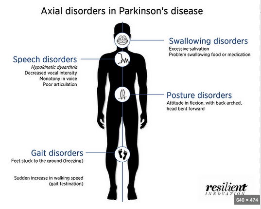 Brief Report: Pallidothalamic Tractotomy by Focused Ultrasound for ...